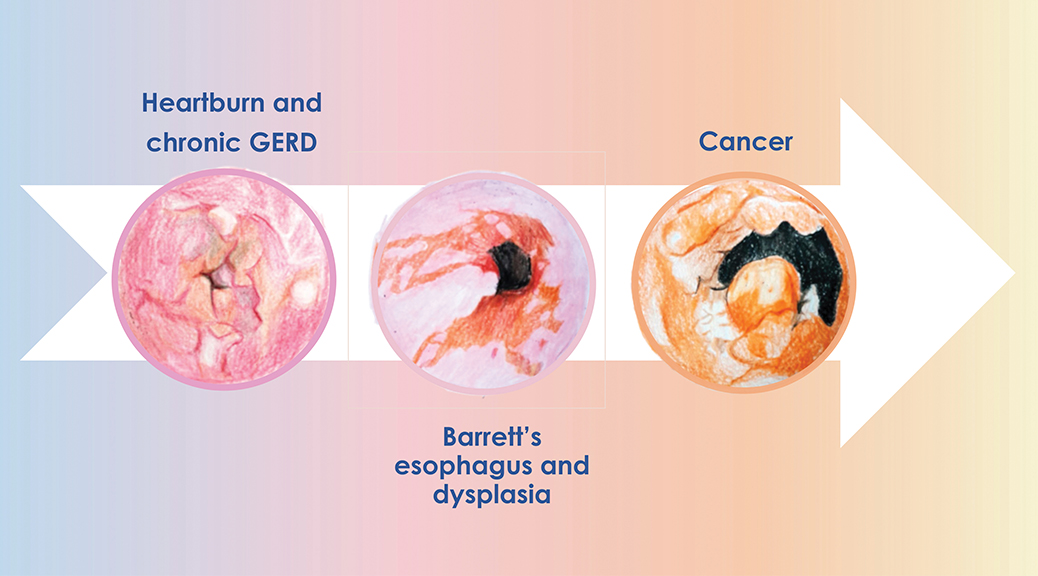 What do I need to know about Gastro-Esophagus Cancer? | EZ MALAYSIA.NEWS